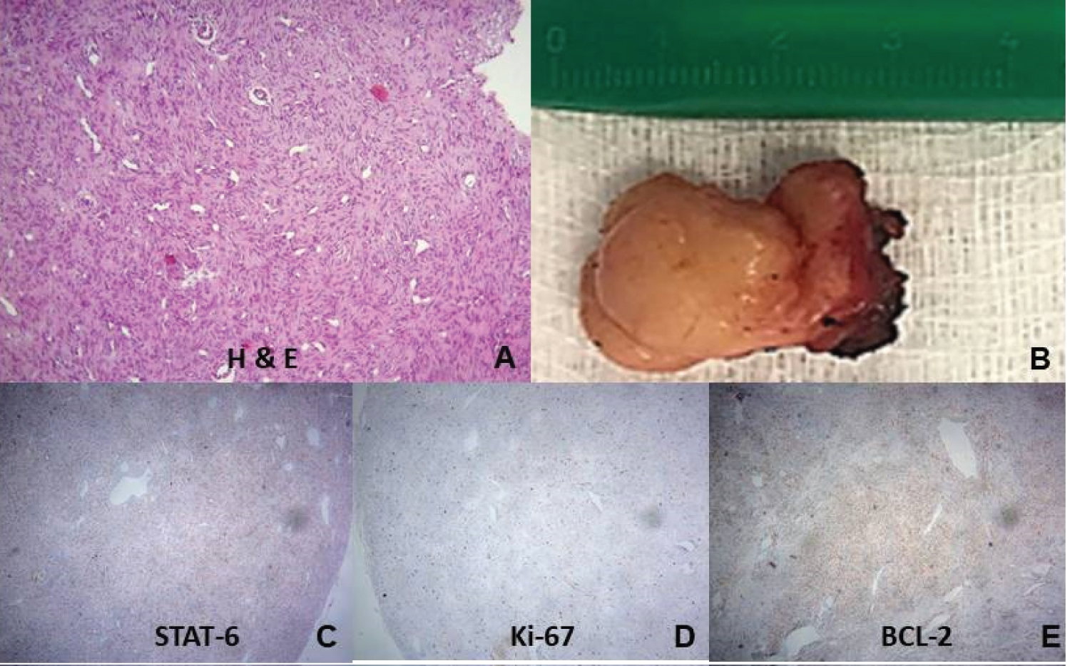 Subcutaneous Solitary Fibrous Tumor A Case Report