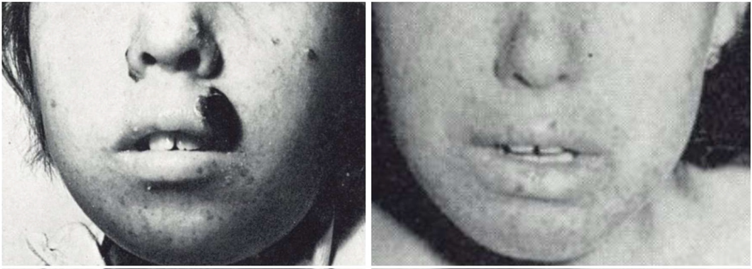 Xeroderma Pigmentosum: A Defying Problem